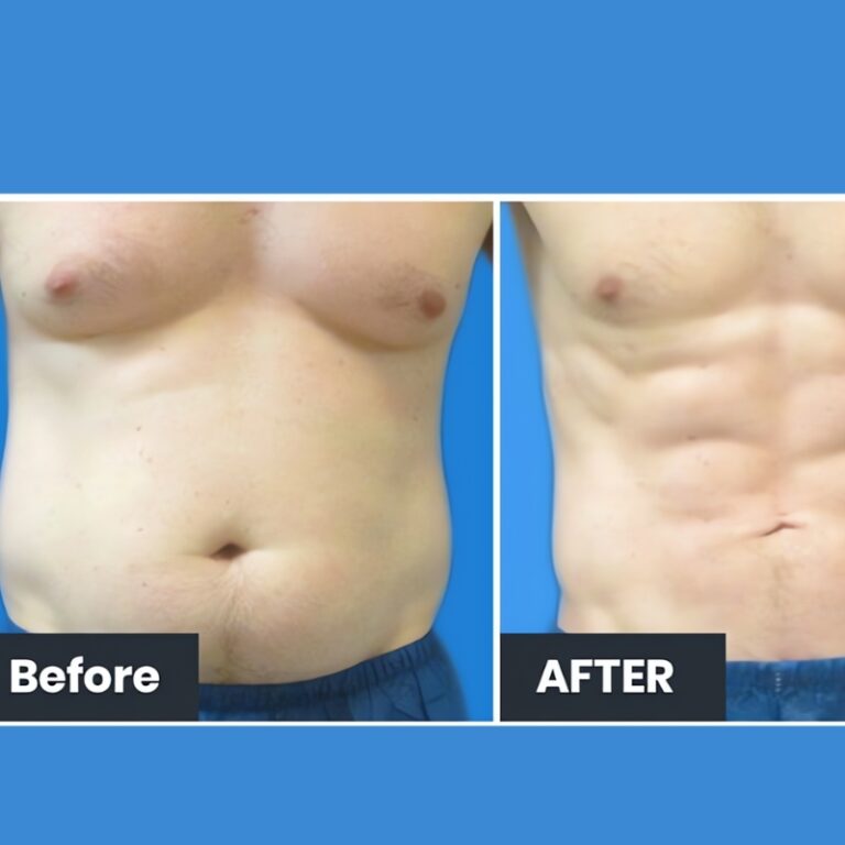 Sono Bello Laser Liposuction - Silver Institute - Integrative Medicine ...